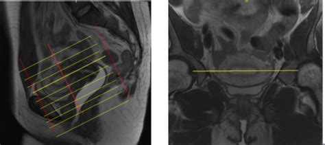 Soft Tissue Pelvis Exam Flashcards Quizlet