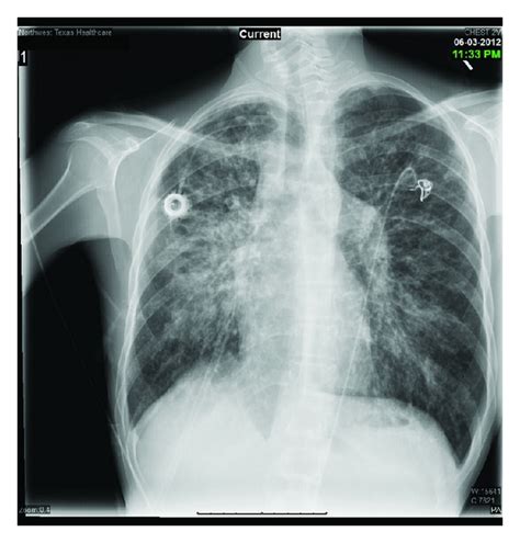 What Is Chest X Ray Infiltrate At Christian Brown Blog