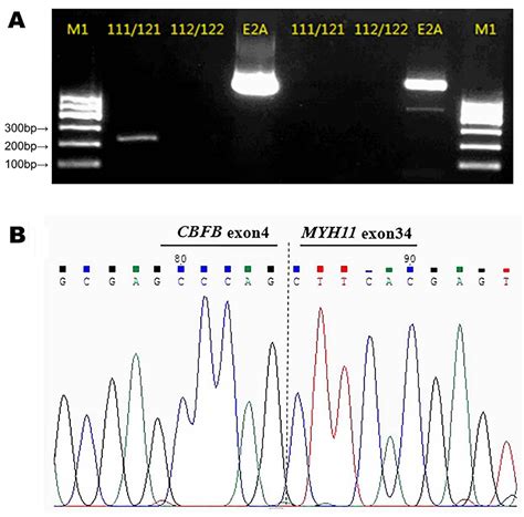 Rare Type I Cbfβ Myh11 Fusion Transcript In Primary Acute Myeloid