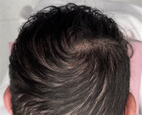 Occipital Scalp Healed Incision Dr Barry Eppley Explore Plastic Surgery