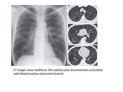 Bronchiectasis Presentation1pptx