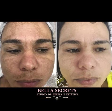 Melasma Tratamento No Brasil