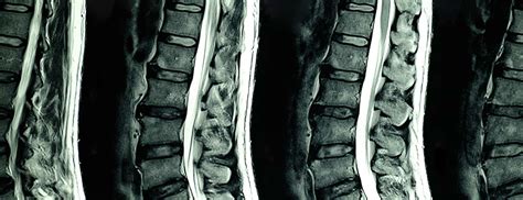 Subarachnoid Cyst Spinal Meningitis