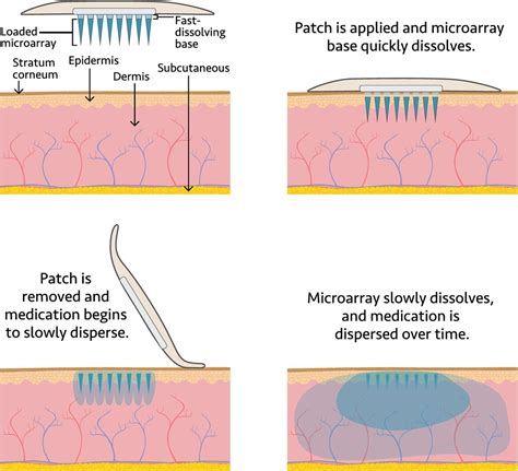 Frontiers Microarray Patch For Hiv Prevention And As A Multipurpose Prevention Technology To