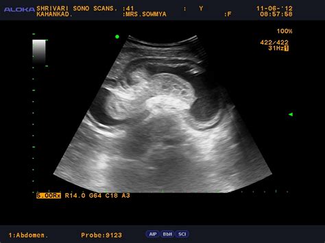 Shrivari Sono Scans Small Bowel Intussusception Secondary To Inflammatory Fibroid Polyp Of The