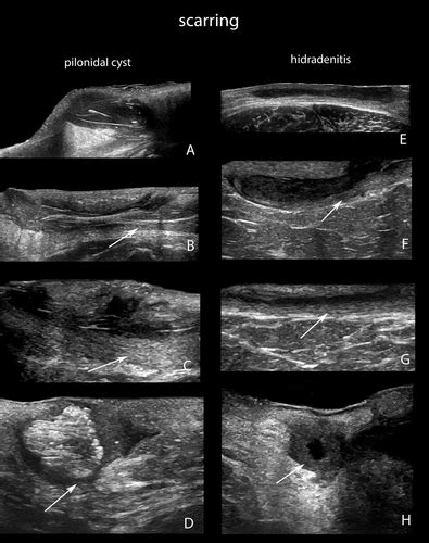 Sonographic Comparison Of Morphologic Characteristics Between Pilonidal