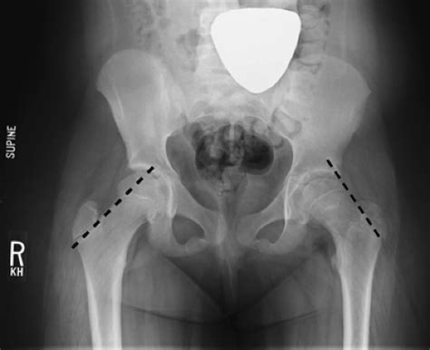 Slipped Capital Femoral Epiphysis Kleins Line