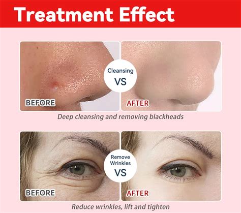 Hydra Beauty Skin System Hydrodermabrasion Facial Machine Hydrodermabrasion Machine Oxygen Jet