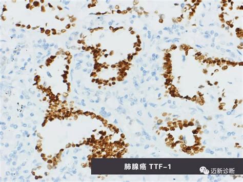 病理为何要做免疫组化之肺癌实战篇诊断