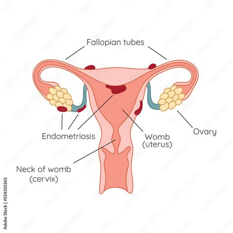 Endometriosis The Appearance Of The Disease Endometriosis Endometrium