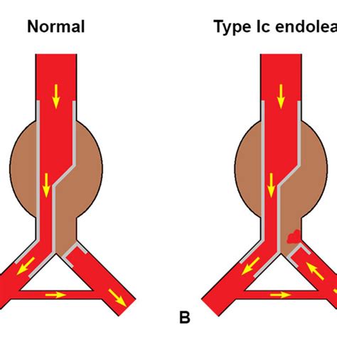 Type Ii Endoleak A Schematic Representation Of An Abdominal Aortic