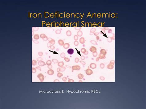 Ppt Anemia Powerpoint Presentation Free Download Id 1450910