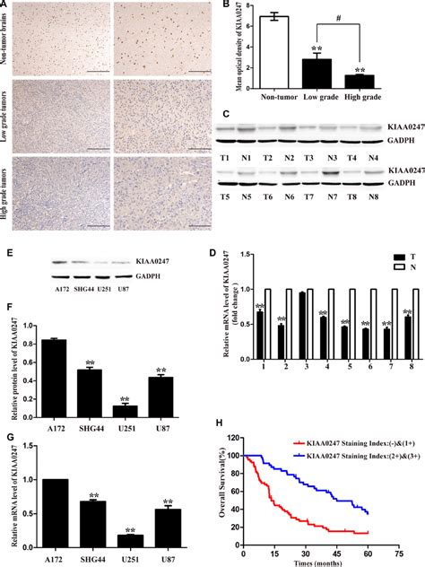 Low Kiaa0247 Expression Predicted A Worse Prognosis For Patients With