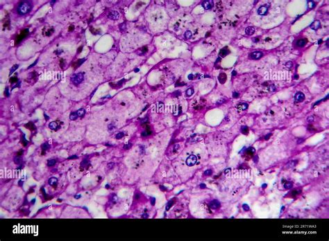 Histopathology Of Alcoholic Hepatitis Light Micrograph Photo Under
