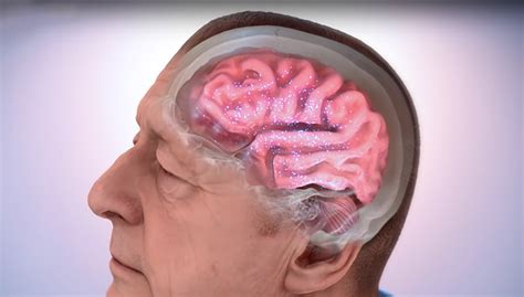 Five Subtypes Of Alzheimers Identified Dementia Variants Differ In
