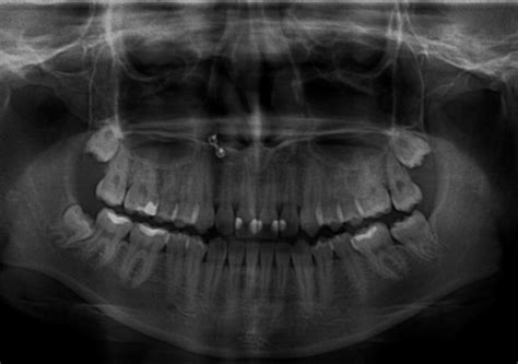 A Simple Surgical Approach For Management Of The Rhinoliths Case