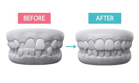 Evolution Of Clear Aligners From 1945 Tooth Positioner To Ai Driven Aligners