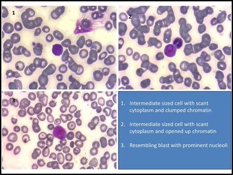 Case Of The Month Dr Narender Tejwani Consultant Hematopathologist
