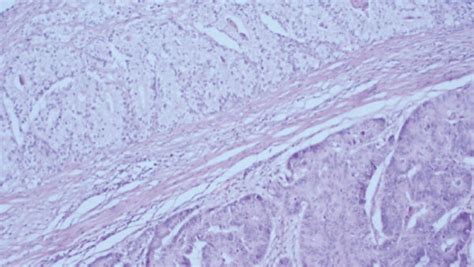 Hande Slides Demonstrate Colonic Adenocarcinoma With A Clear Cell