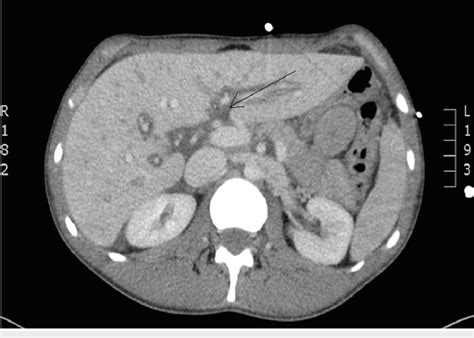 CT Abdomen And Pelvis With IV Contrast Demonstrating Periportal Edema Download Scientific