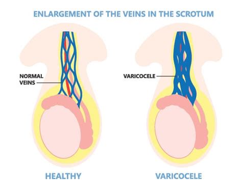 Varicocele Repair Los Angeles And San Francisco Ca