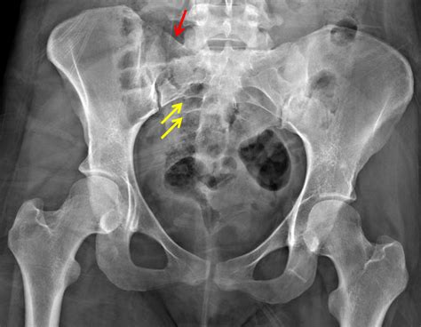 Closed Fracture Of Sacrum Boothtery