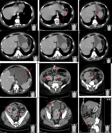 Ct Abdomen And Pelvis After Administration Of 94 Ml Of Omnipaque 350 Ct Abdomen And Pelvis After Administration Of 94 Ml Of Omnipaque 350