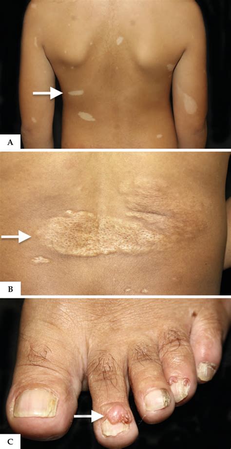 Tuberous Sclerosis Adenoma Sebaceum