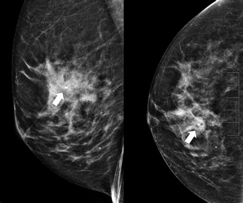 How To Perform Stereotactic Mammographic Guided Biopsy Radiology