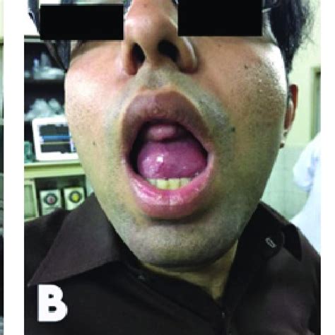 A Extra Oral Frontal View Of The Giant Dermoid Cyst B Intra Oral