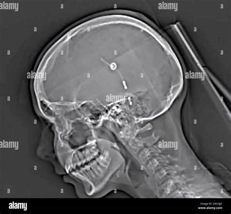 Cerebral Shunt X Ray Image Showing The Placement Of A Ventriculo