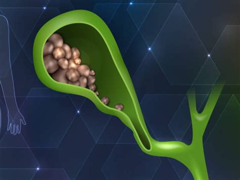 预防ercp术后胰腺炎：放置胆管支架前要不要乳头肌切开？ 医学界 助力医生临床决策和职业成长