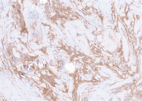 A Separate Fibrous Fragment With Psammomatous Calcifications And