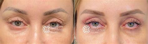 Blepharoplasty Scars How Long Does It Take To Heal