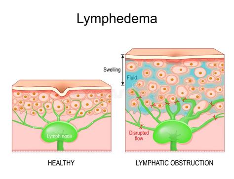 Lymphatic Obstruction Stock Illustrations 14 Lymphatic Obstruction