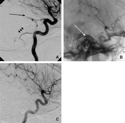 Selective Angiography Of Left Internal Carotid Artery Demonstrating