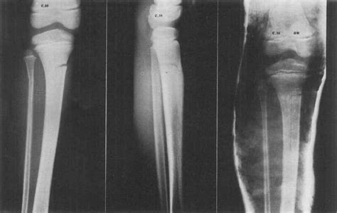 File Fracture Of The Proximal Tibial Metaphysis  Wikism