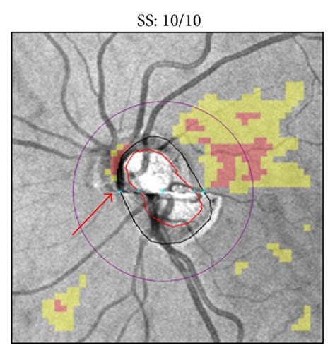 Motion Artifacts And Scan Circle Displacement Pair Of Cirrus Hd Oct
