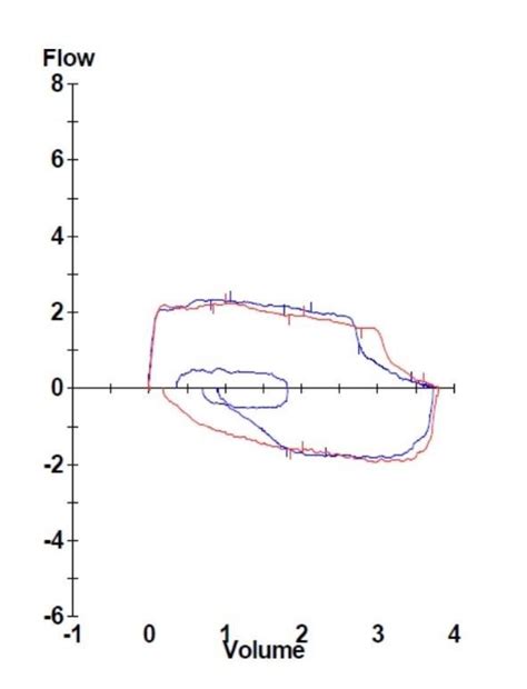 Flow Loop Demonstrating Fixed Large Airway Obstruction Download