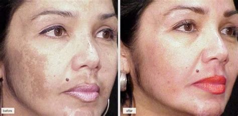 Skin Discoloration Cream Best Prevention And Treatment Methods Esc