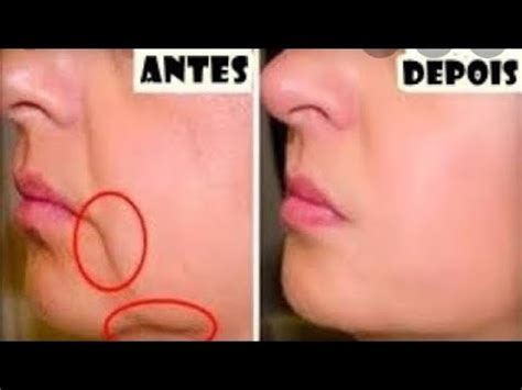USE E EXPULSE 20 ANOS DE MANCHAS RUGAS E MELASMA YouTube