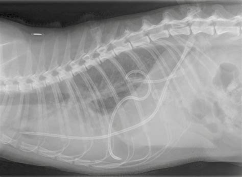 Pyothorax A Unique Case Of Tension Empyema Caused By Prevotella