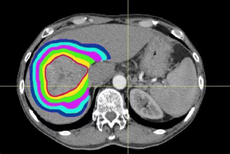 Uninvolved Liver Dose Prediction In Stereotactic Body Radiation Therapy For Liver Cancer Based