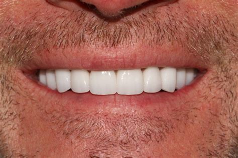 Before After Gallery 19th Street Dental