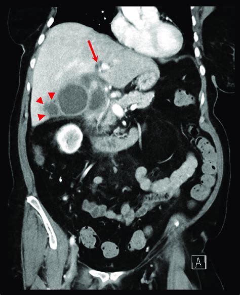 Coronal Computed Tomography Revealing Intrahepatic Biliary Ductal