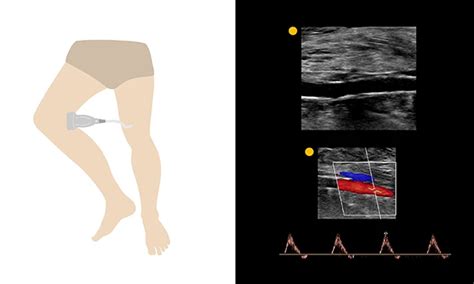 Mastering An Arterial Duplex Protocol Medmastery
