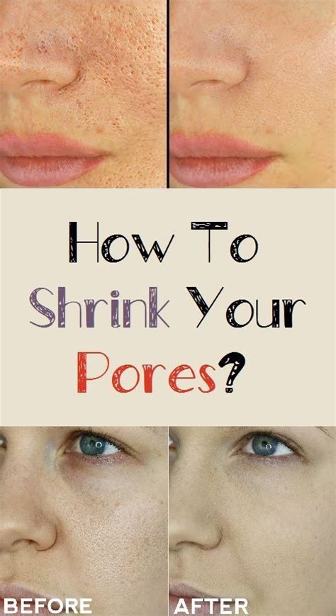 How To Clear Clogged Pores And Acne Howtoremvo