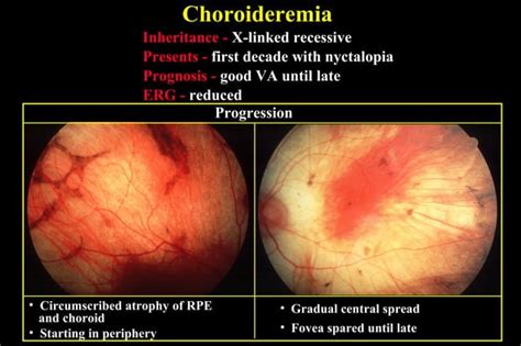 47 Hereditary Choroidal Dystropathies Ppt Eye And Vision Conditions Diseases And Conditions