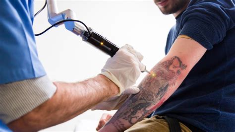 Eliminación de tatuajes YouTube