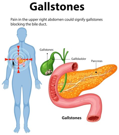 Free Vector Understanding Gallstones And Their Effects